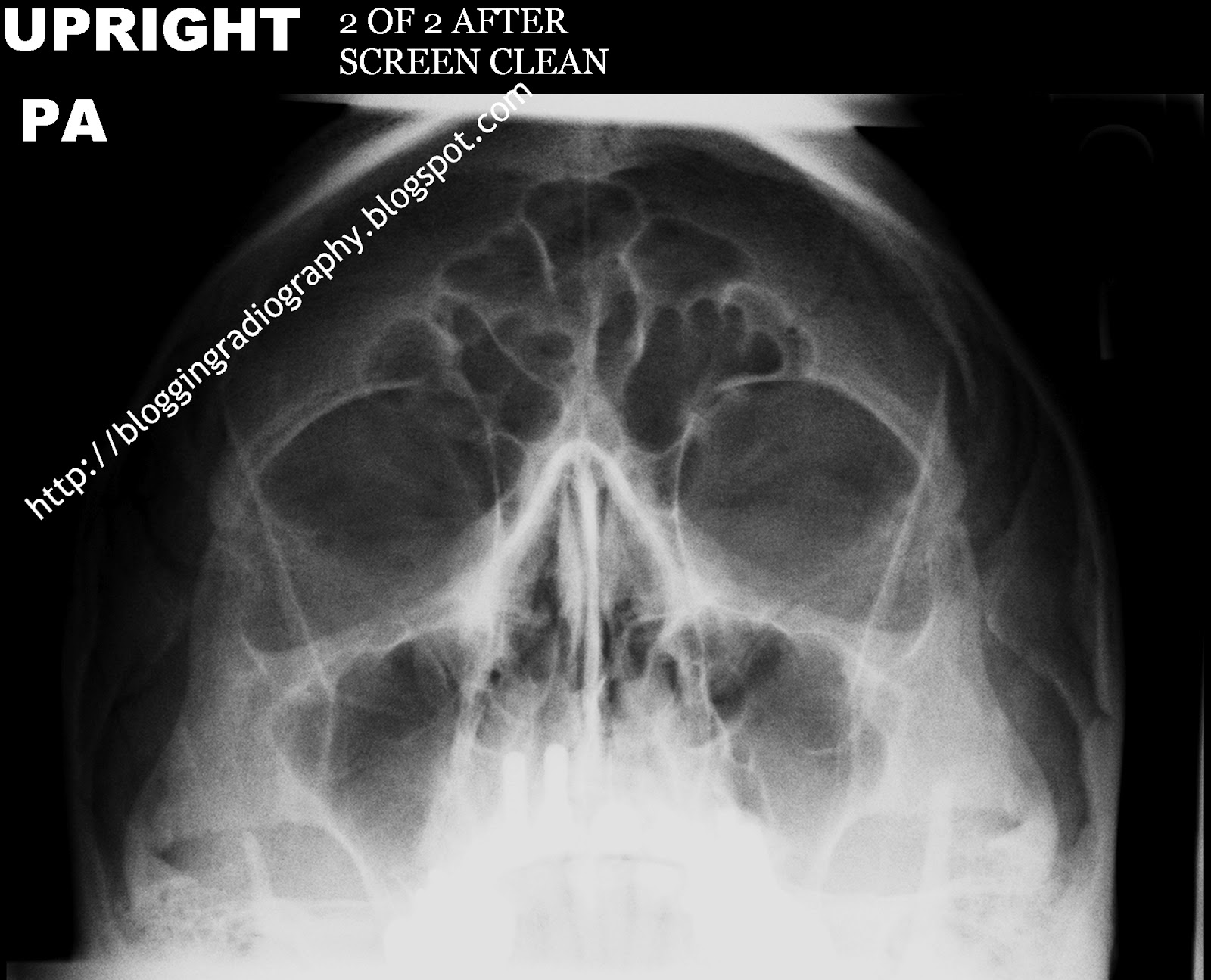 Topics in Radiography: Orbits for MRI Clearance