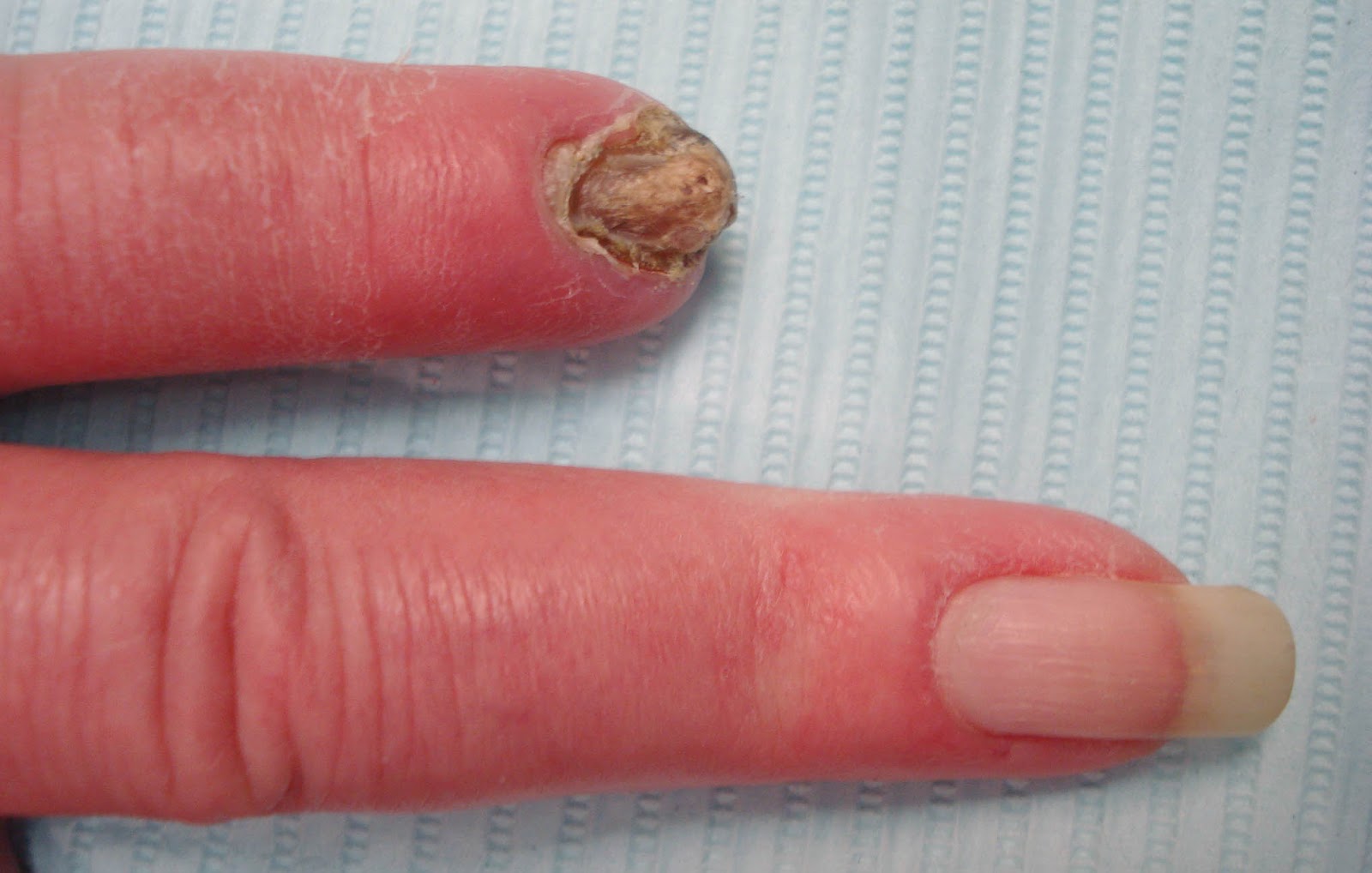 VIRTUAL GRAND ROUNDS IN DERMATOLOGY 2.0: Raynaud's with Digital ...