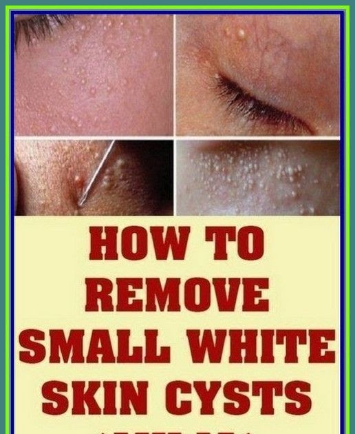 Milia: How To Remove The Small White Skin Cysts? - wellness days