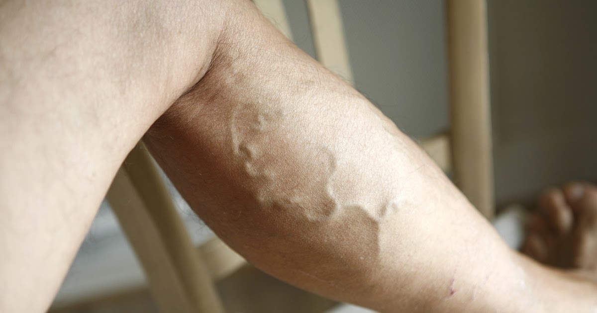 6 módszer, ami visszér ellen beválik: megelőzhető velük a lábdagadás és ...