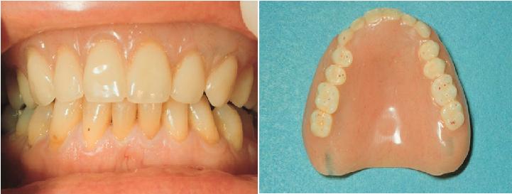 Dentistry lectures for MFDS/MJDF/NBDE/ORE: A Note ON Immediate Dentures ...