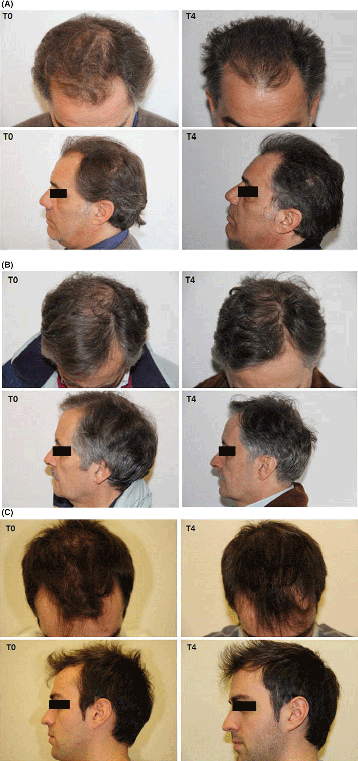Michael Scally Md Mostly Androgens Clinical Efficacy Of A Cosmetic
