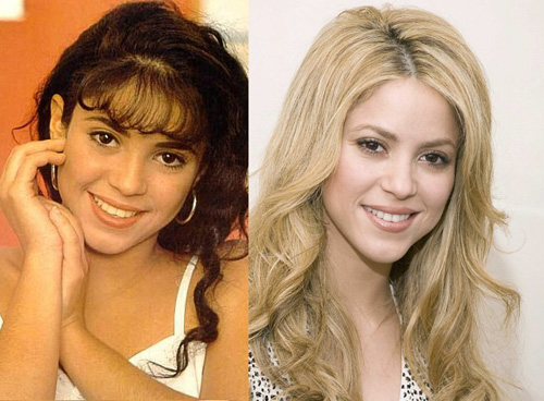 Shakira Plastic Surgery