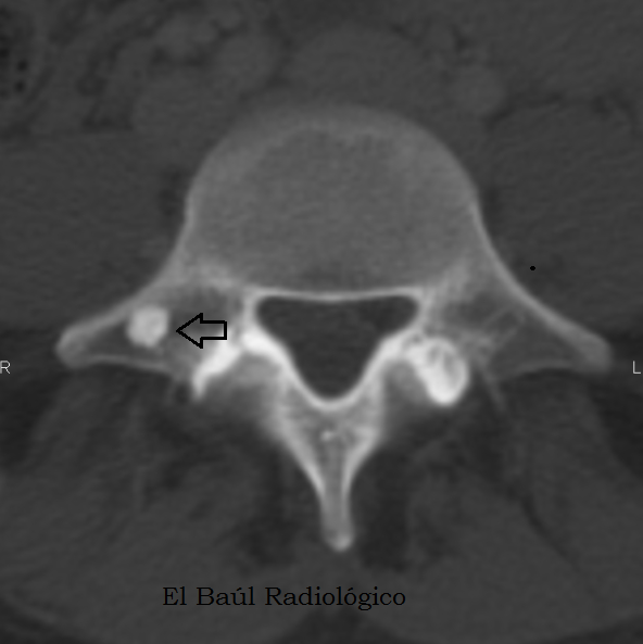 El Baúl Radiológico: ENOSTOSIS: ISLOTE ÓSEO (Bone Island: CT and MRI ...