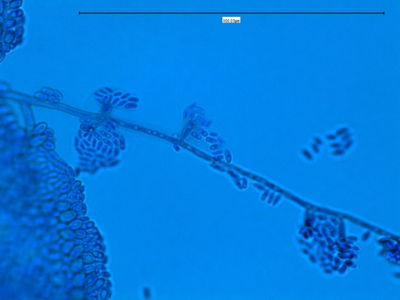 Fun With Microbiology (What's Buggin' You?): Exophiala dermatitidis