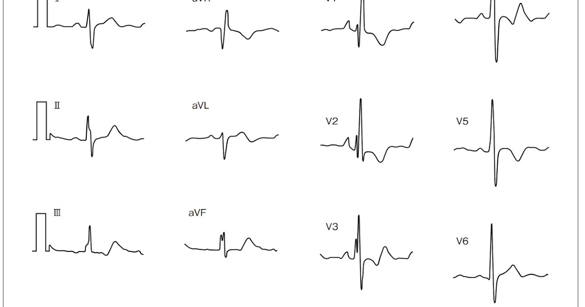 松下 ER ランチ・カンファレンス: 心電図：かぎ針パターン Crochetage pattern
