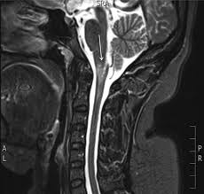 Esclerosis-Multiple-MSblog: Sindrome de Area Postrema en NMOSD