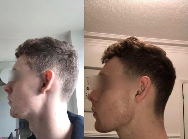 Những điều bạn cần biết về mewing ~ The beausty