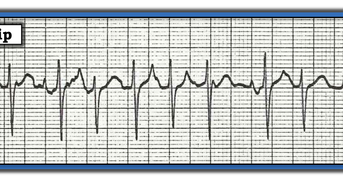 Wandering Atrial Pacemaker Rhythm Strip