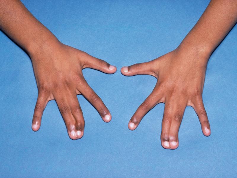 Semiologia Pediátrica - Sindactilia