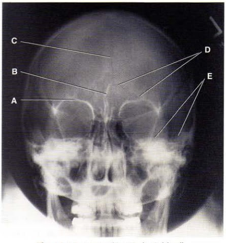 AXIAL PA 15° GRADOS METODO DE CALDWELL