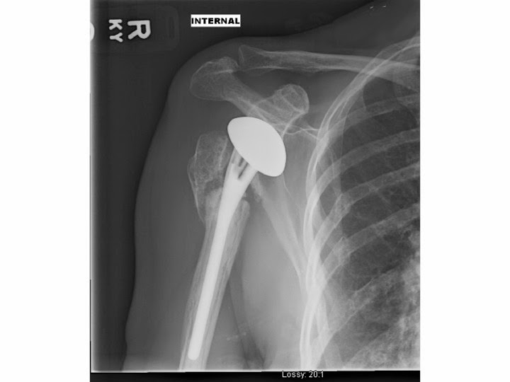 Shoulder and Elbow Surgery: Reverse shoulder replacement for failed ...