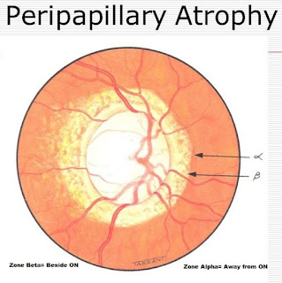 Choroidal Crescent Optic Nerve
