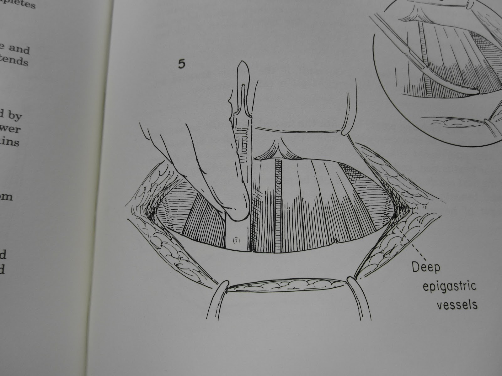 The Pfannenstiel Incision: Opening and Closing the Tummy