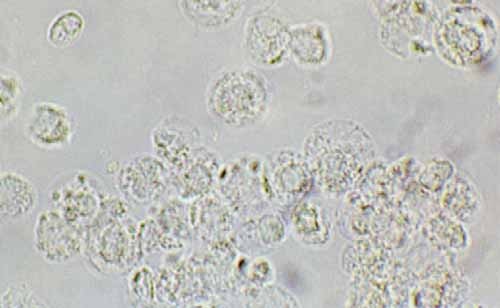 [Haematology] Microscopic Examination of Urinary Sediment - Cells ...