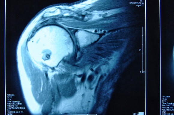 RODILLA Y HOMBRO: MANGO ROTADOR.