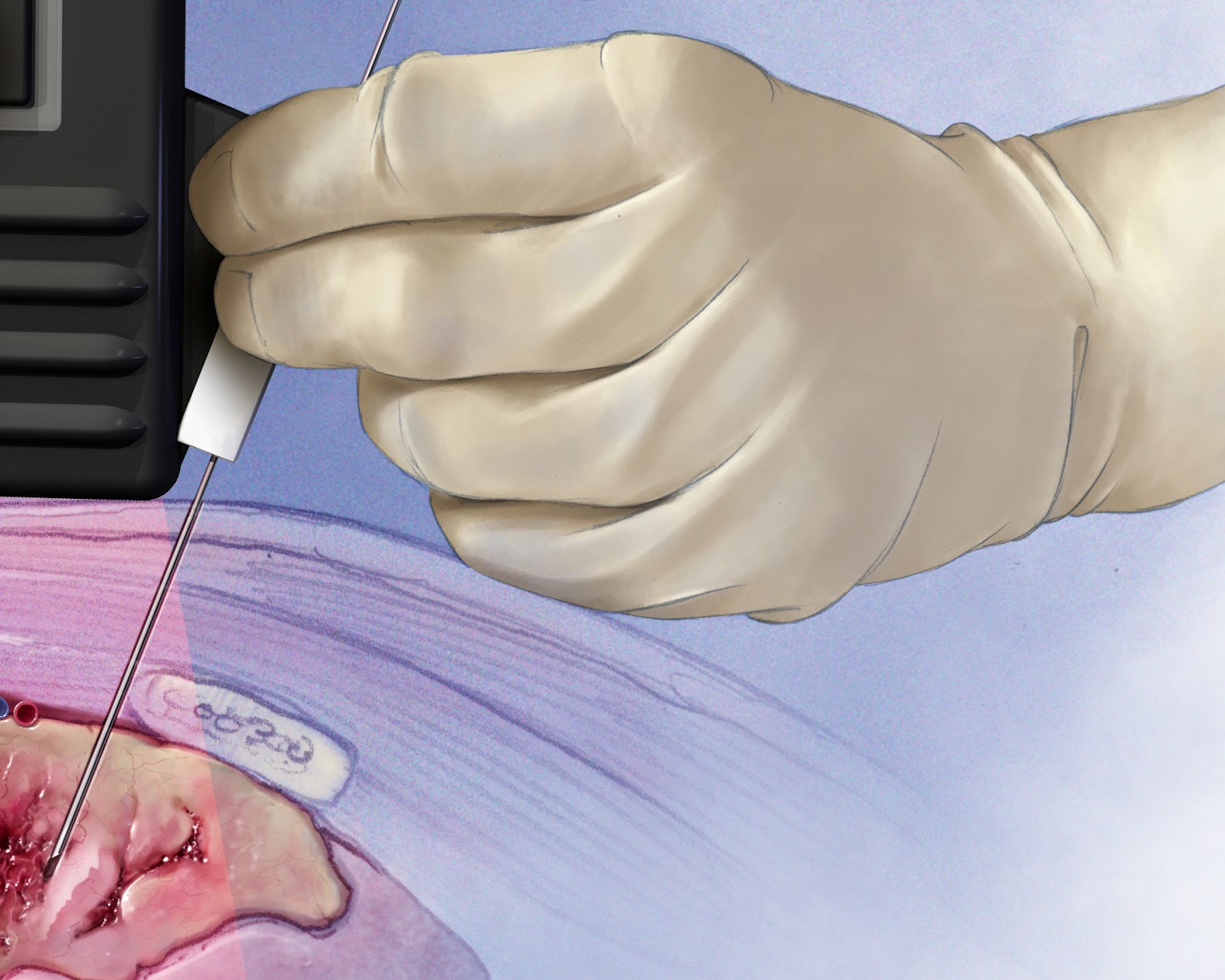 Corl Medical Media: Ultrasound Guided Biopsy, 2003
