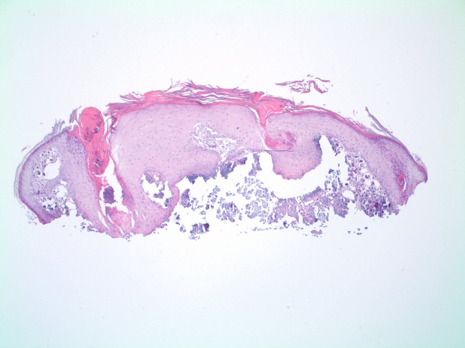 Dermatopathology: Subepidermal calcified nodule