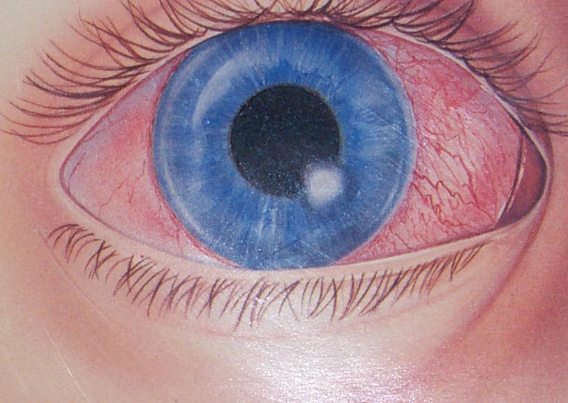 EyeFacts – by Dr. Brad Wicklund: Corneal Ulcer