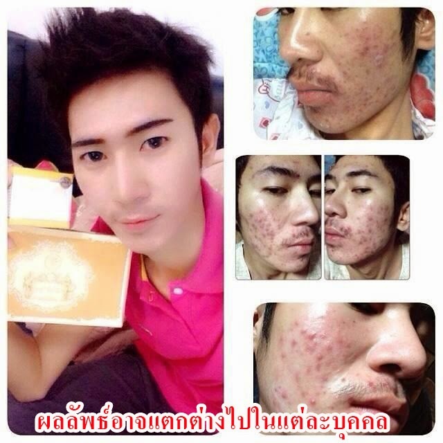 #1 Thailand Skin Whitening Products: Freshy Face Gold Set Users Before ...