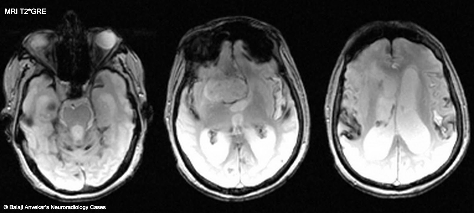Dr Balaji Anvekar FRCR: Superficial Siderosis MRI Brain
