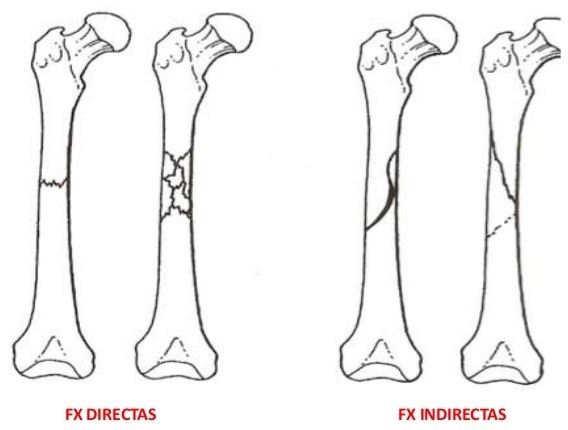 Generalidades de Fracturas