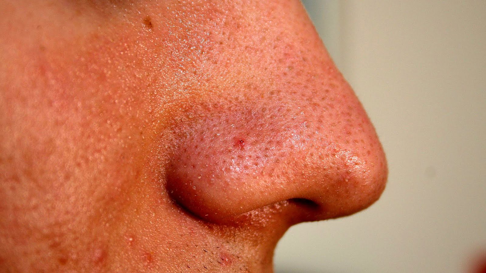 Comedo - Blackhead On Face - Black Choices