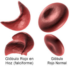 Anemia de Células Falciformes en Niños: Fotos