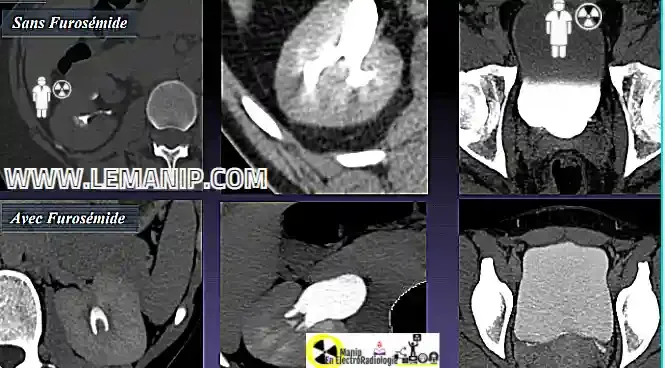 L’UroScanner Sur Mesure : Etude De La Voie Excrétrice