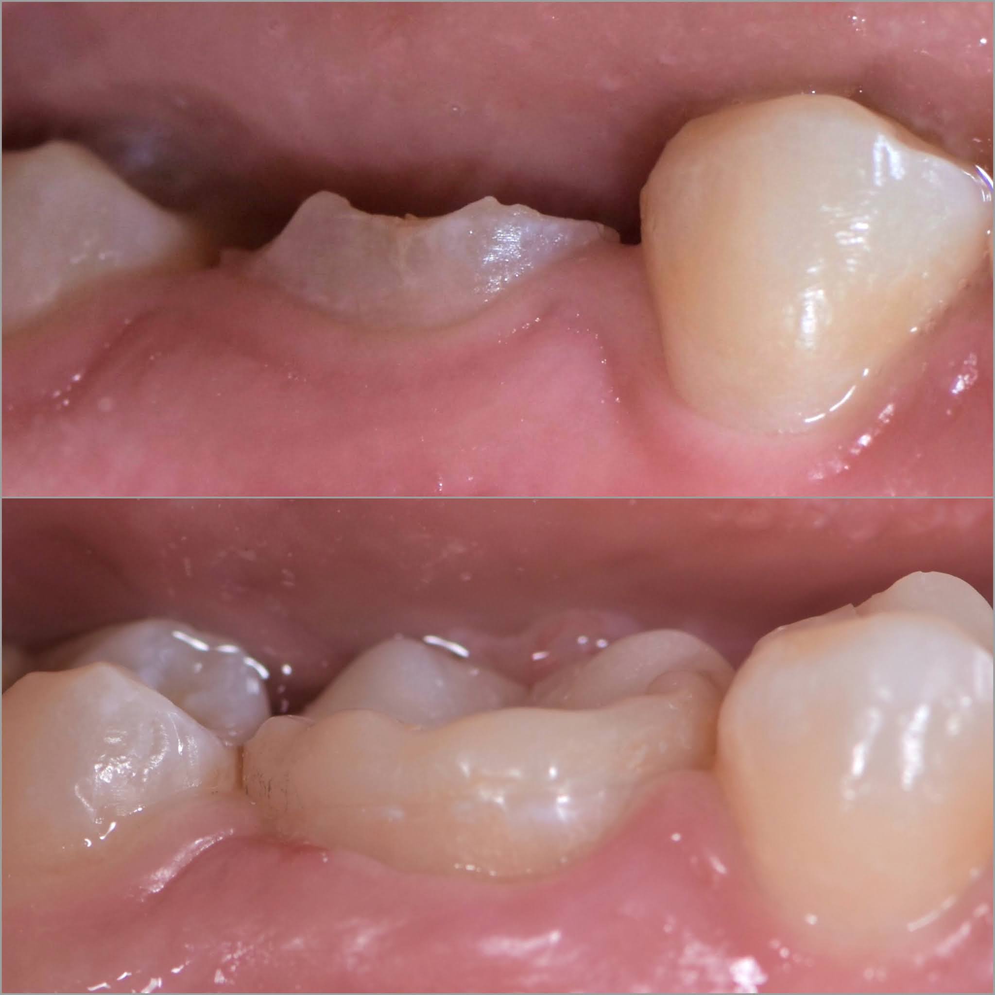 Endocrown .. Full documentation of a clinical case | Dental Esthetics