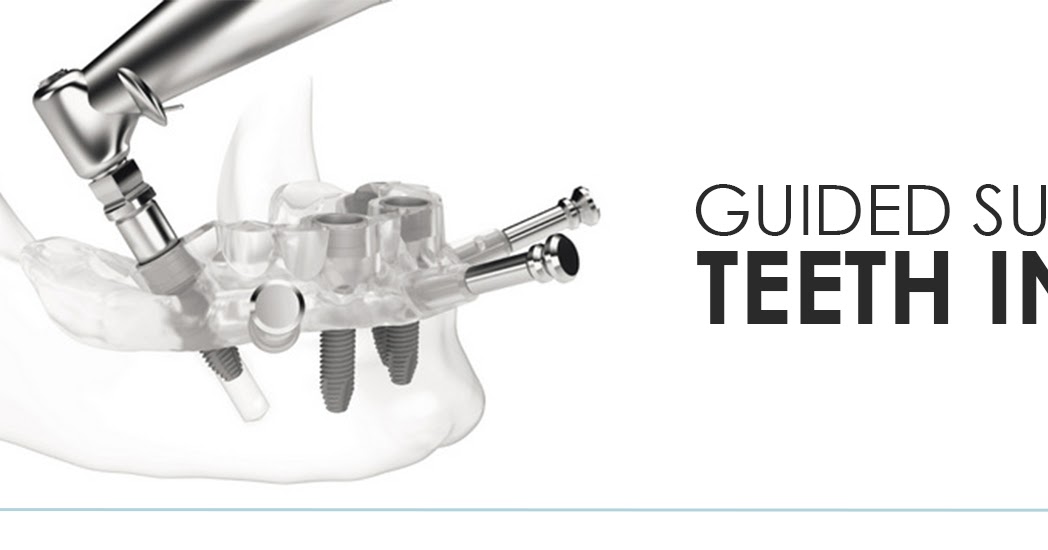 What is the Recovery time for Full Mouth Flapless Keyhole Immediate All ...