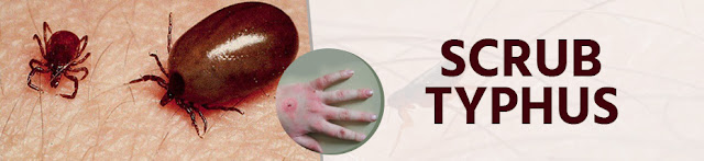 Signs of the scrub typhus and the ways to avoid it - Shimla Times