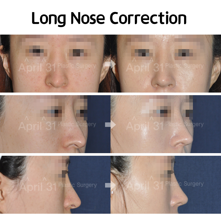 April31 Plastic Surgery Clinic: Long Nose Correction