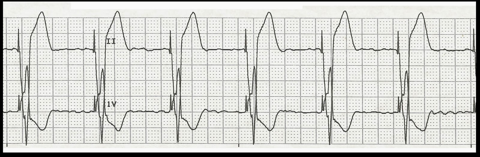 Float Nurse: Practice EKG Rhythm Strips 219