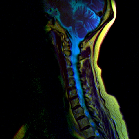Nevit's blog: Cervical spine Color MRI