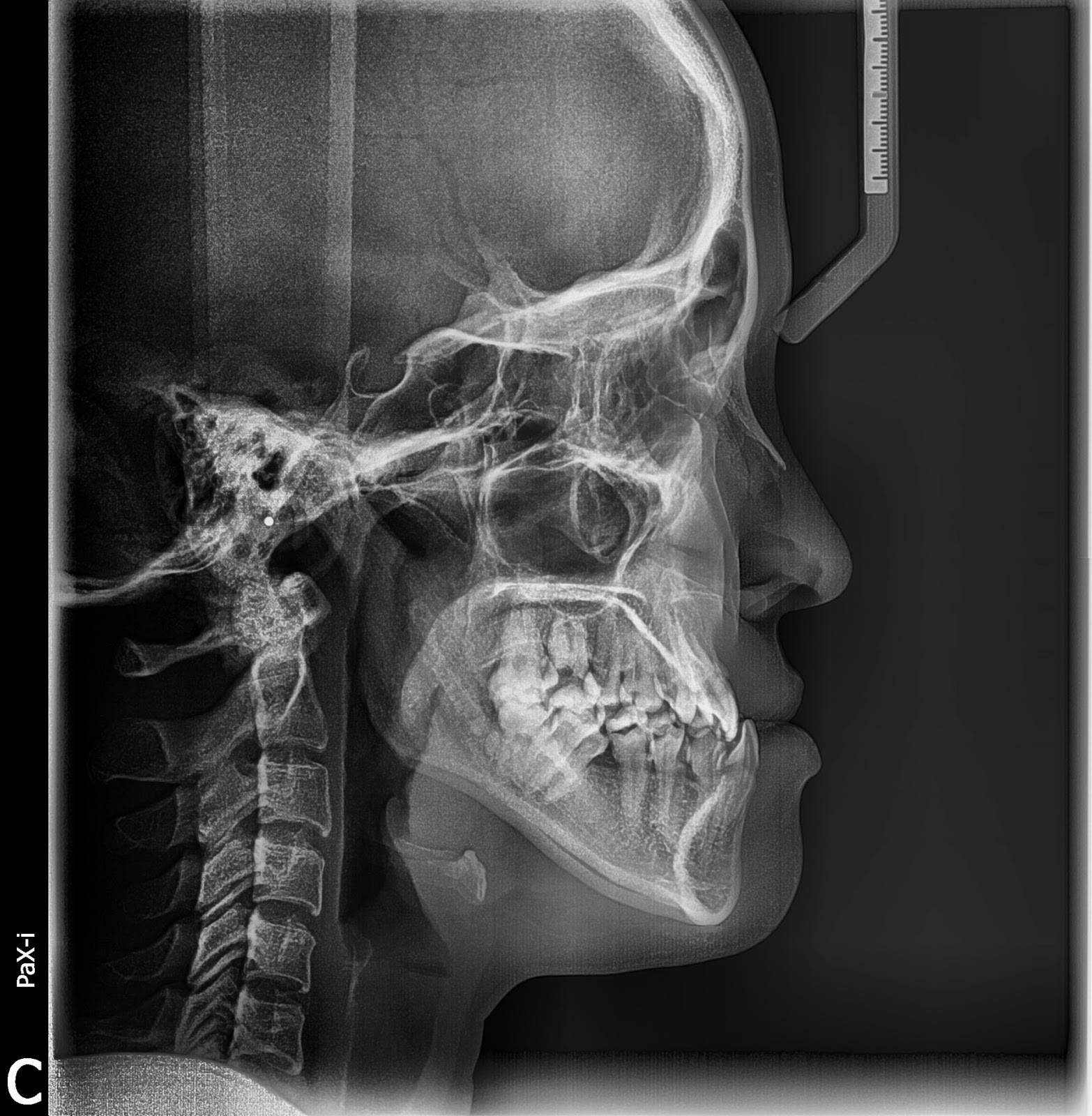 My Braces Journey: September 2016