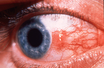 Images For Pingicula ~ YOUNG DOCTORS' RESEARCH FORUM