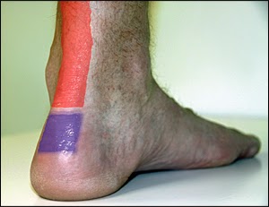 DrMitrPhysio: CHELT therapy in the treatment of chronic insertional ...