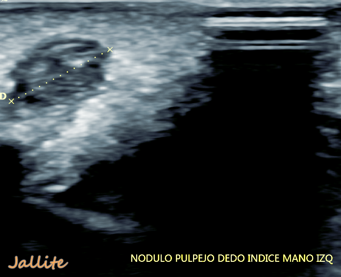 Nódulo Solido Pulpejo Dedo Mano