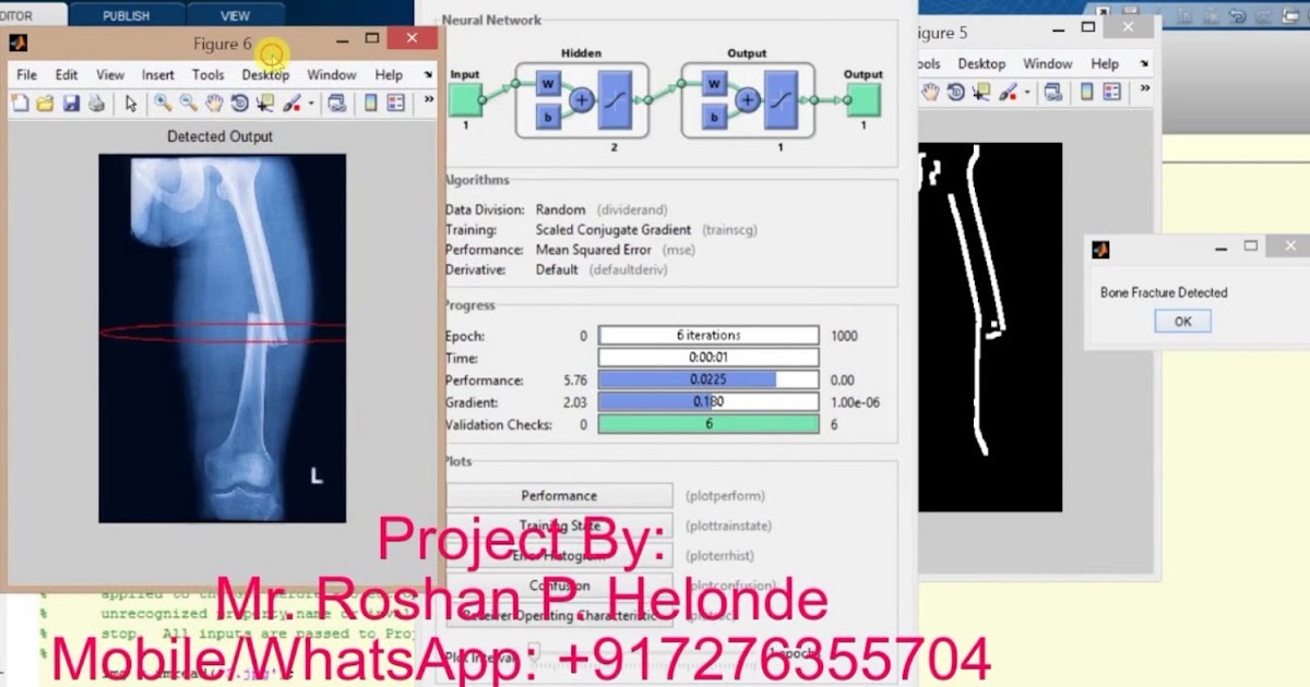 Bone Fracture Detection using Neural Network Matlab Project with source Code ~ ENGINEERING PROJECTS