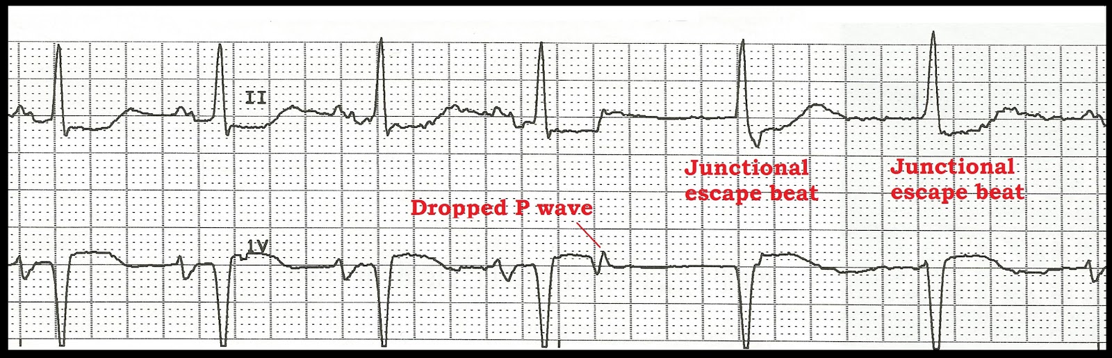 Practice ECG Rhythm Strips 114