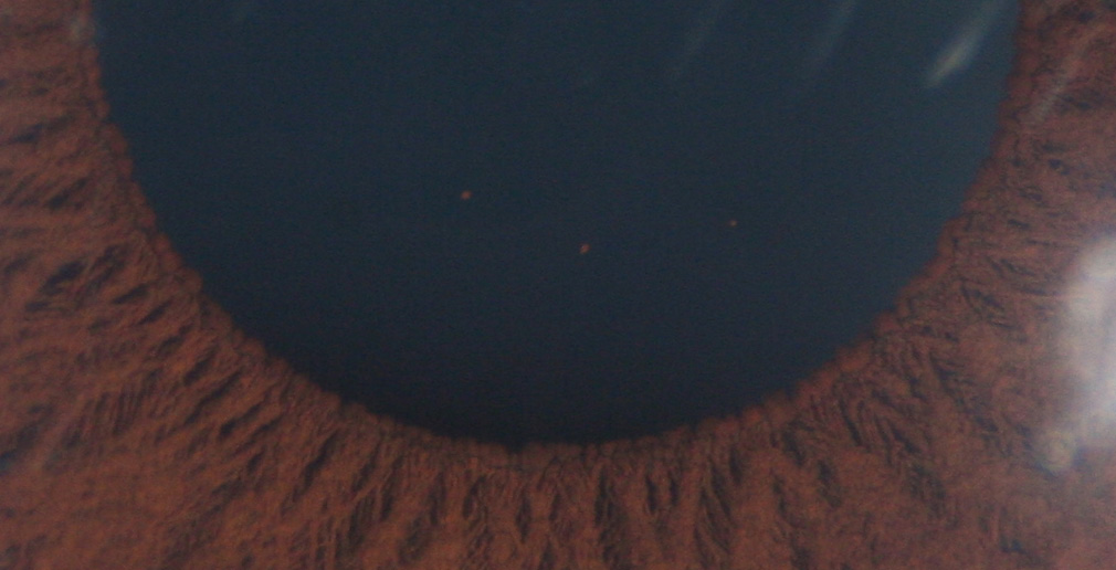 Modern & Multidimensional Iridology: Persistent Pupillary Membrane ...