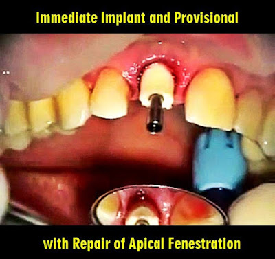 IMPLANTOLOGY: Immediate Implant and Provisional with Repair of Apical ...