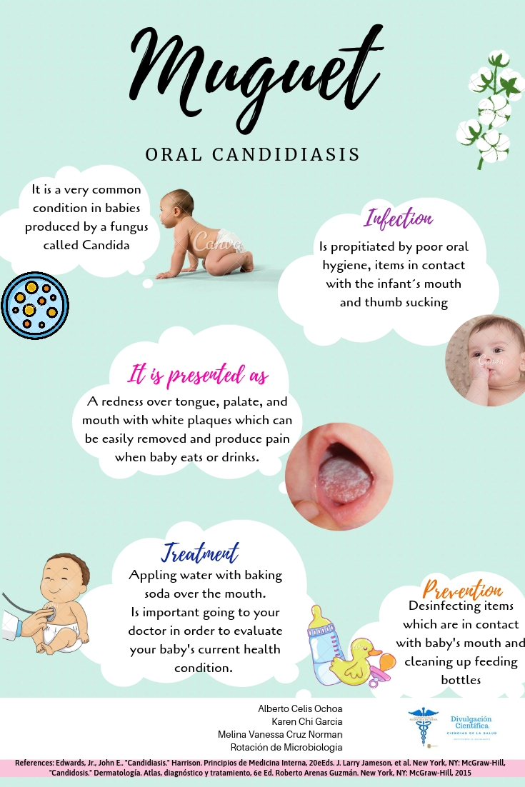 DIVULGACIÓN CIENTÍFICA UG: Oral Candidiasis in children.