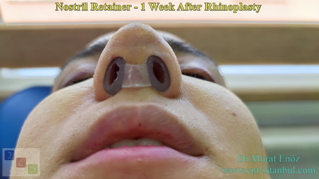 About The Nostril Retainer