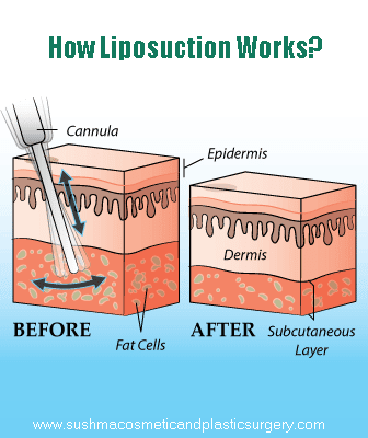 Liposuction-Body Contouring Erases Stubborn Body Fat ~ Cosmetic and ...