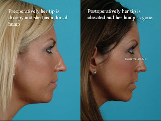 Dr. Dean Toriumi Reviews: Dean Toriumi Reviews: Patient presented with ...