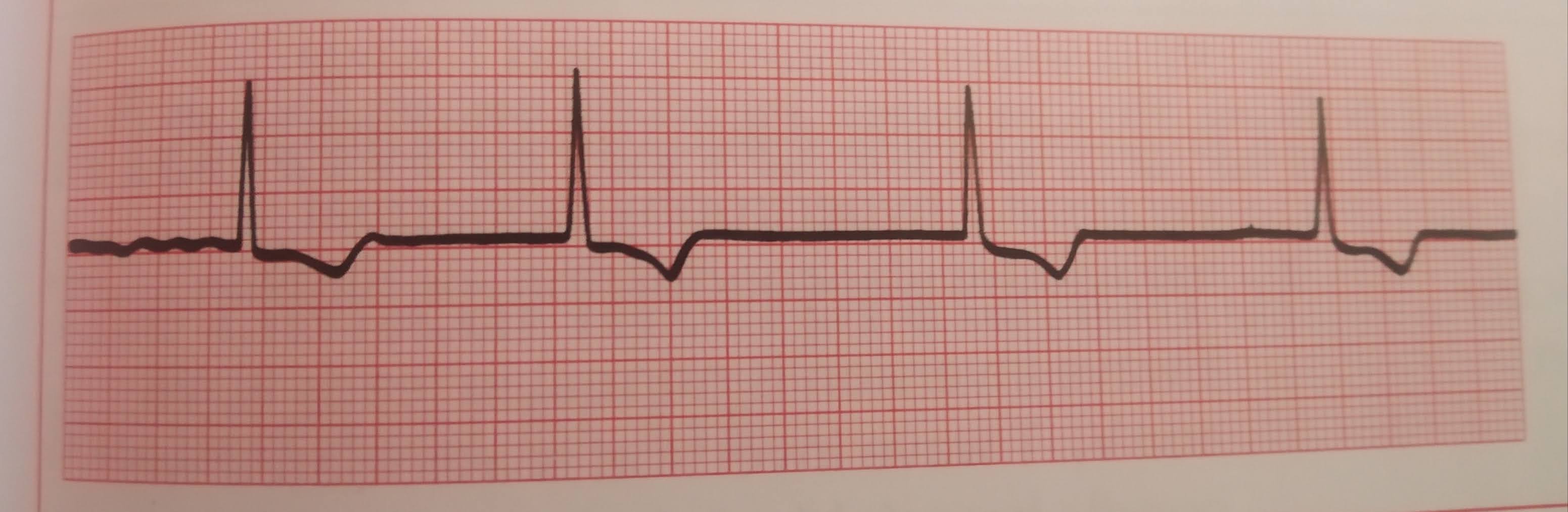DIGOXIN EFFECT ON ECG (OVERVIEW)