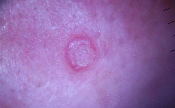 VIRTUAL GRAND ROUNDS IN DERMATOLOGY 2.0: Solitary Tricholemmoma