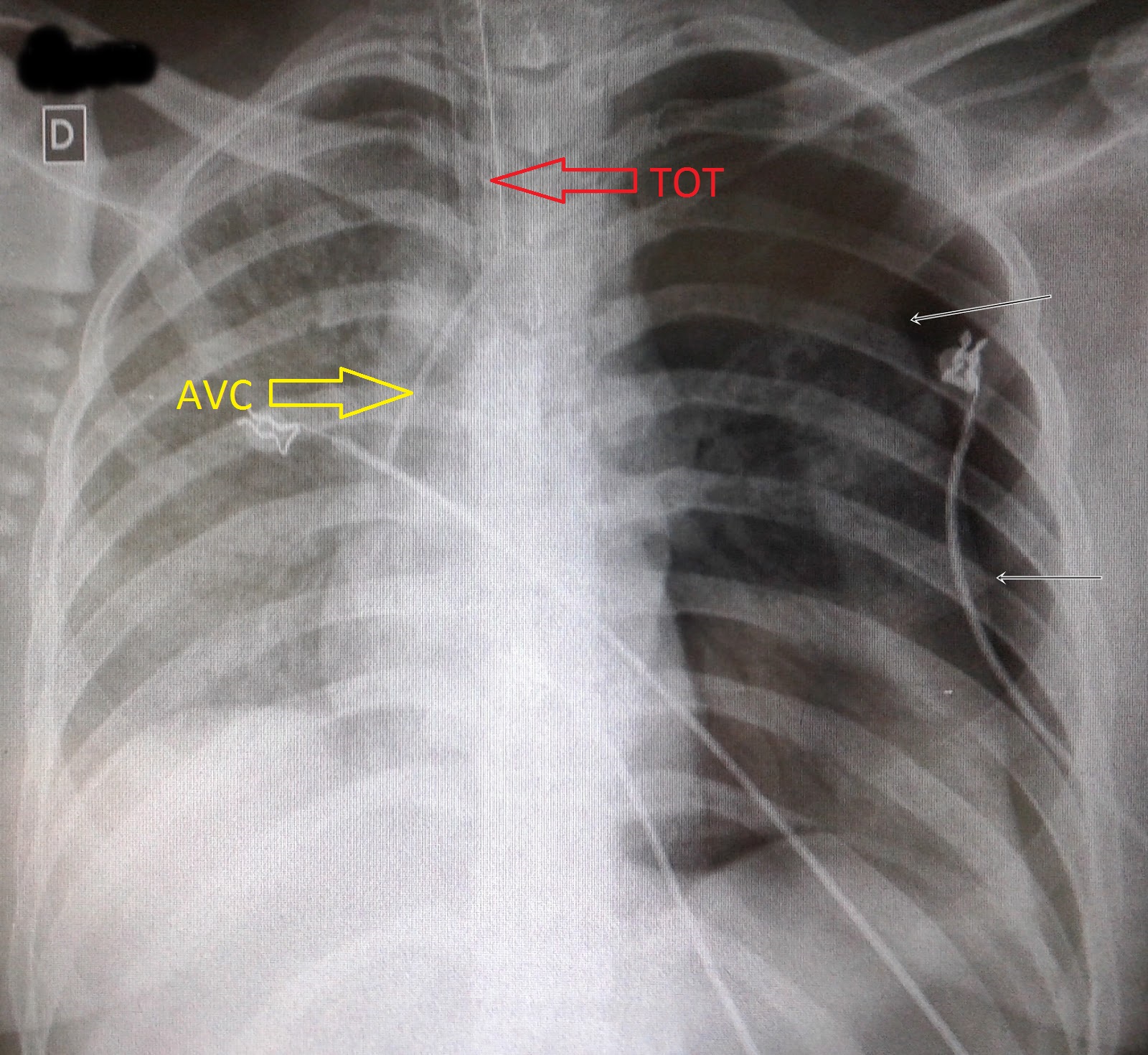 Raio X Do Tuberculo Adutor